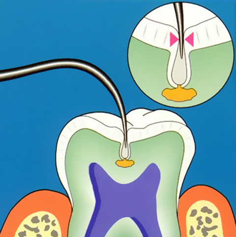 Tooth Decay | FirstBite Dental | Essendon Dentist