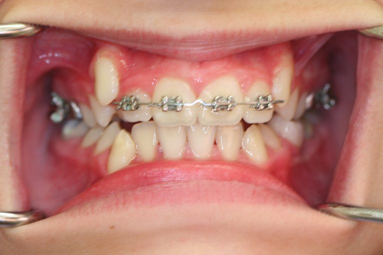 Kids Orthodontics In Melbourne – FirstBite Dental | Essendon Dentist