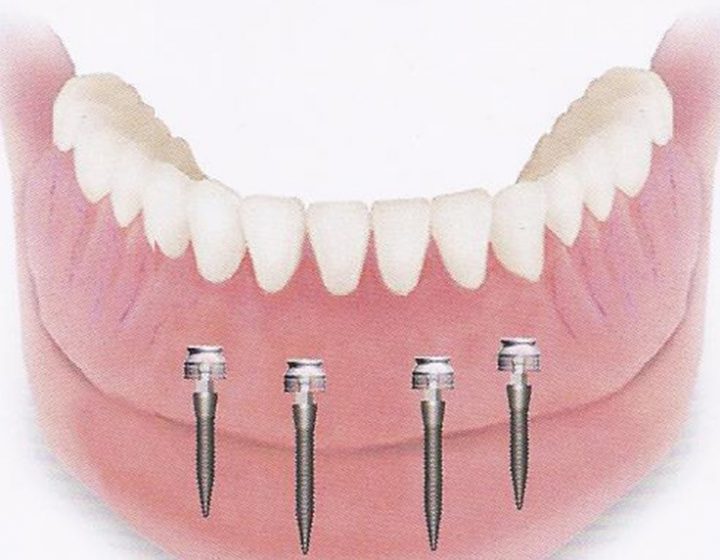 Mini Dental Implants In Essendon – FirstBite Dental | Essendon Dentist