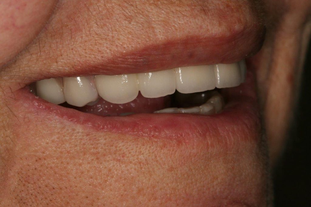 Dentures In Essendon – FirstBite Dental | Essendon Dentist