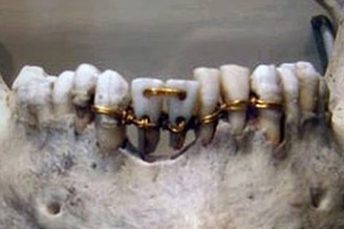 Even the ancient Egyptians lived with TMJ dysfunction (TMD) | FirstBite ...