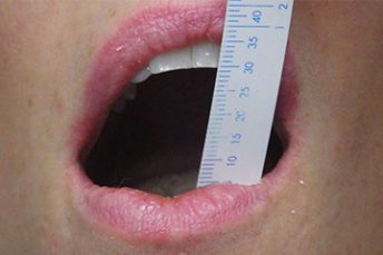 Locked jaw: approach life wide open! | FirstBite Dental | Essendon Dentist