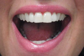 Locked jaw: approach life wide open! | FirstBite Dental | Essendon Dentist